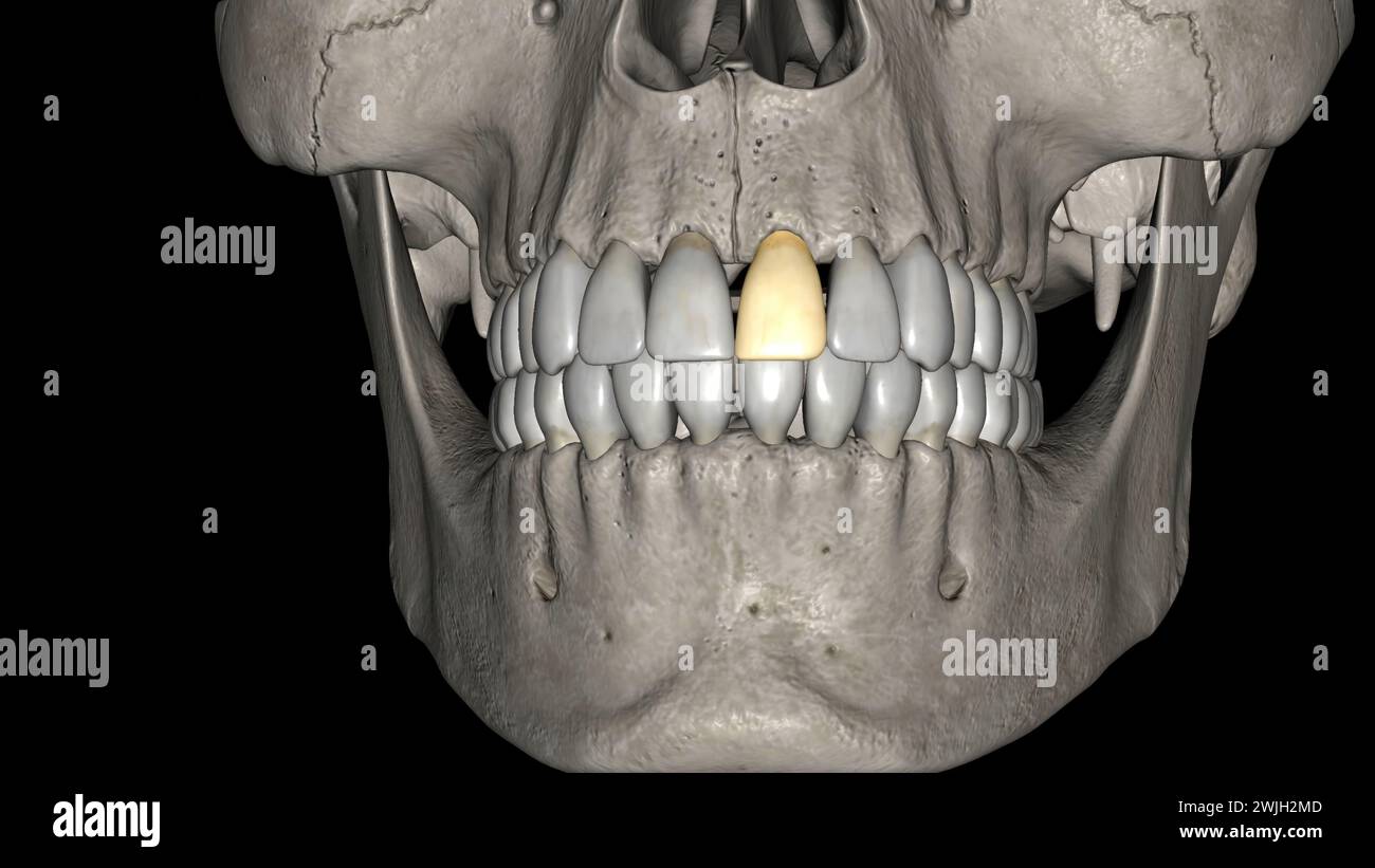 The maxillary central incisors are centered in the maxilla, one on ...