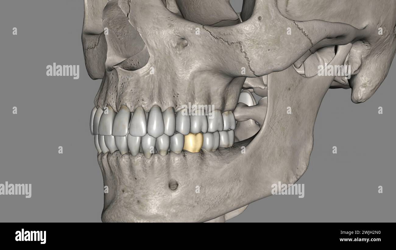 The mandibular first molar usually has two roots, a mesial and a distal ...