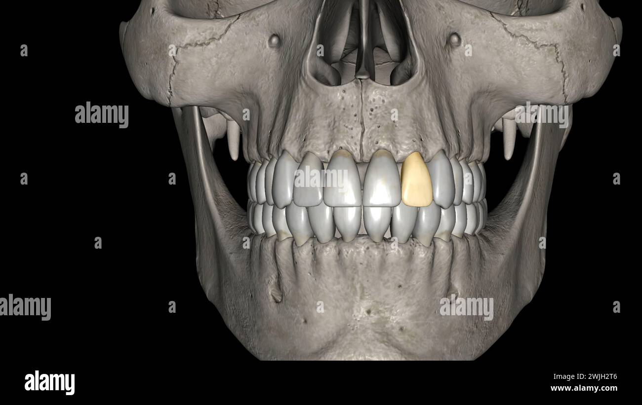 The maxillary lateral incisors are a pair of upper (maxillary) teeth ...