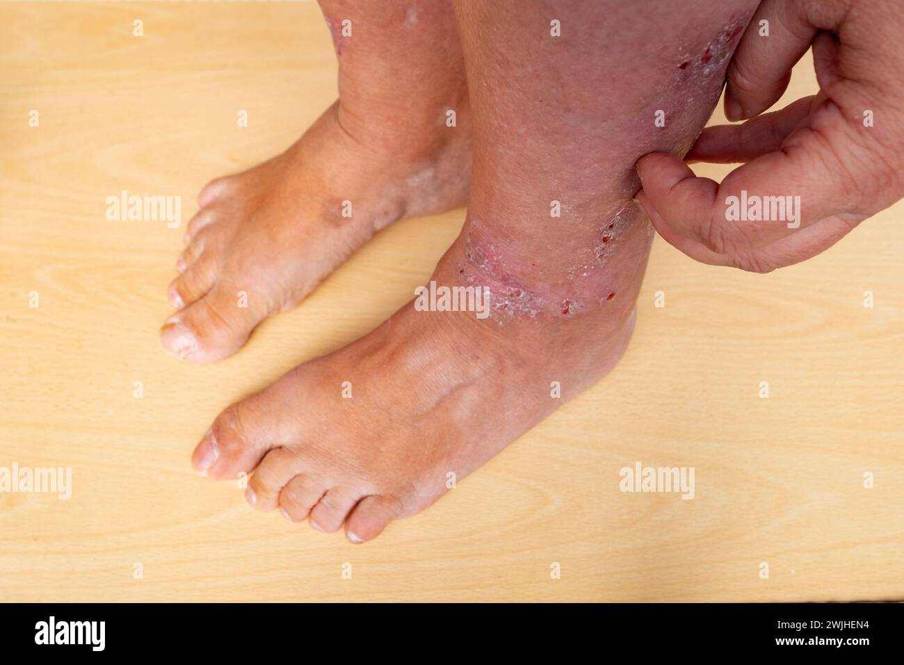 rash, hives, itchy skin on legs, inflammation and Medical Allergies ...