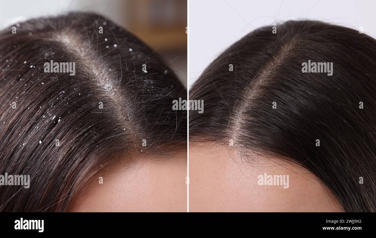 Woman showing hair before and after dandruff treatment, collage Stock ...