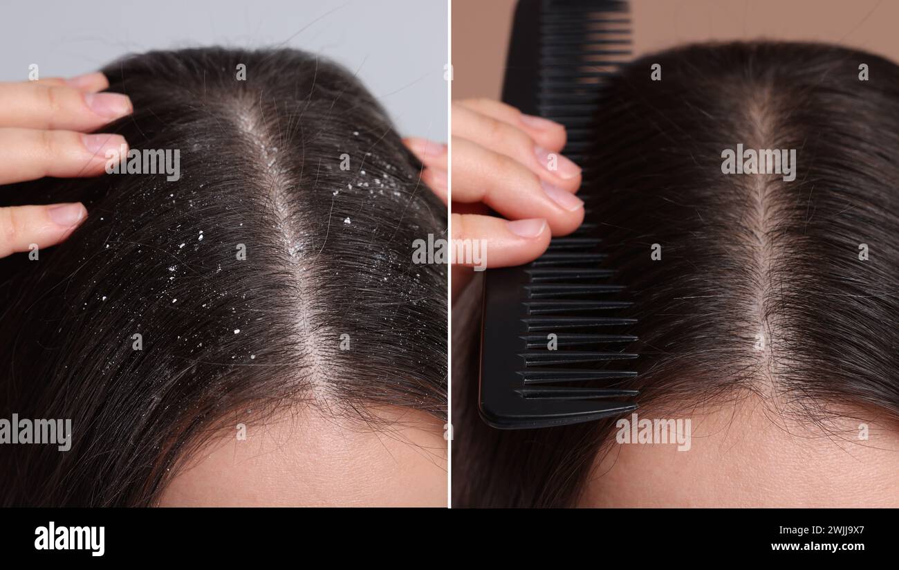 Woman showing hair before and after dandruff treatment, collage Stock ...