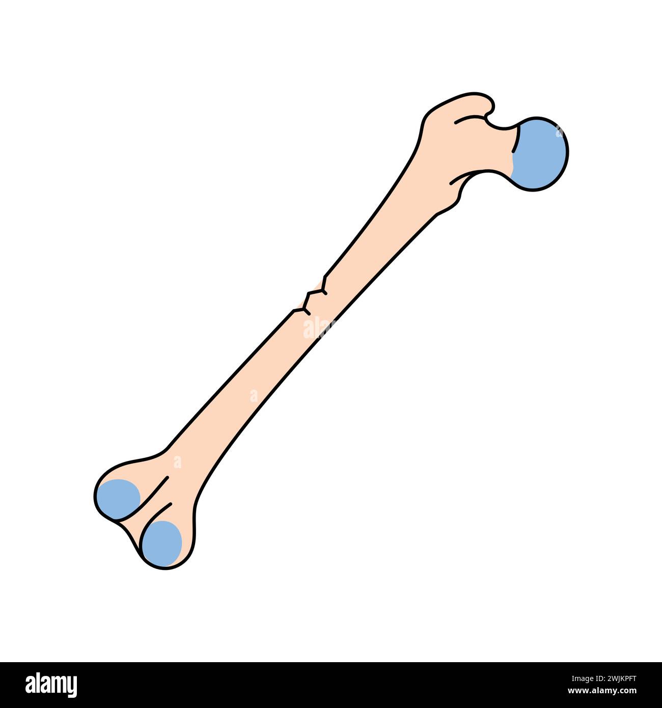 Greenstick bone fracture Stock Vector Images - Alamy