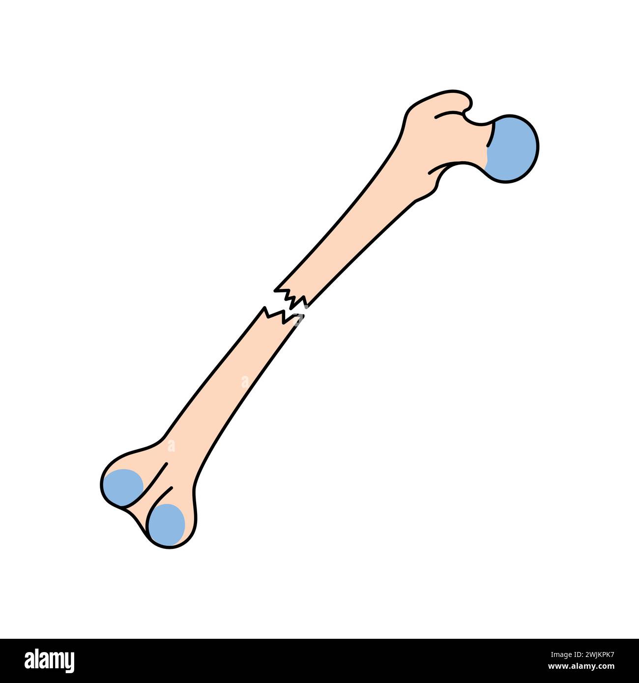 Spiral Bone Fracture Stock Vector Images Alamy