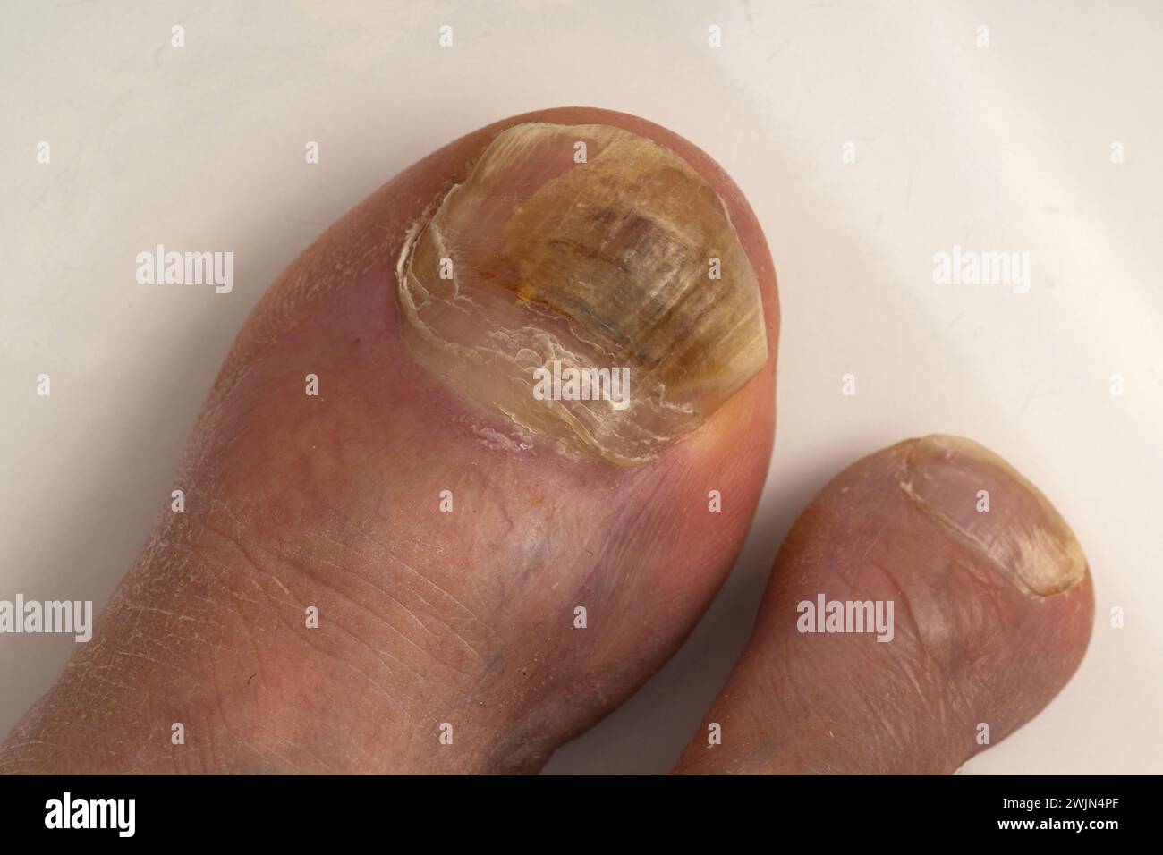 A person's big toe with a damaged nail fungus. Close-up Stock Photo - Alamy