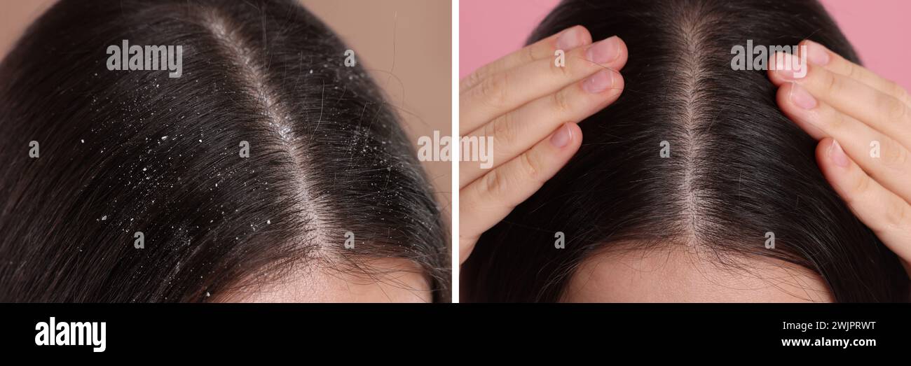 Woman showing hair before and after dandruff treatment on color ...