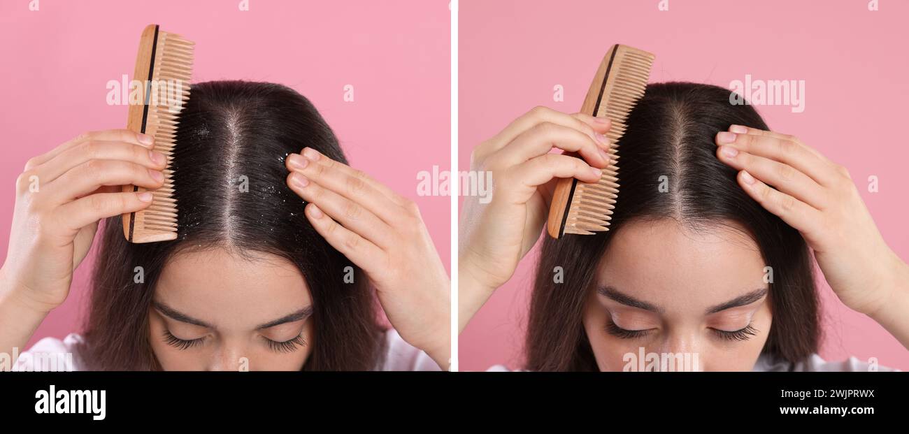 Woman showing hair before and after dandruff treatment on pink ...