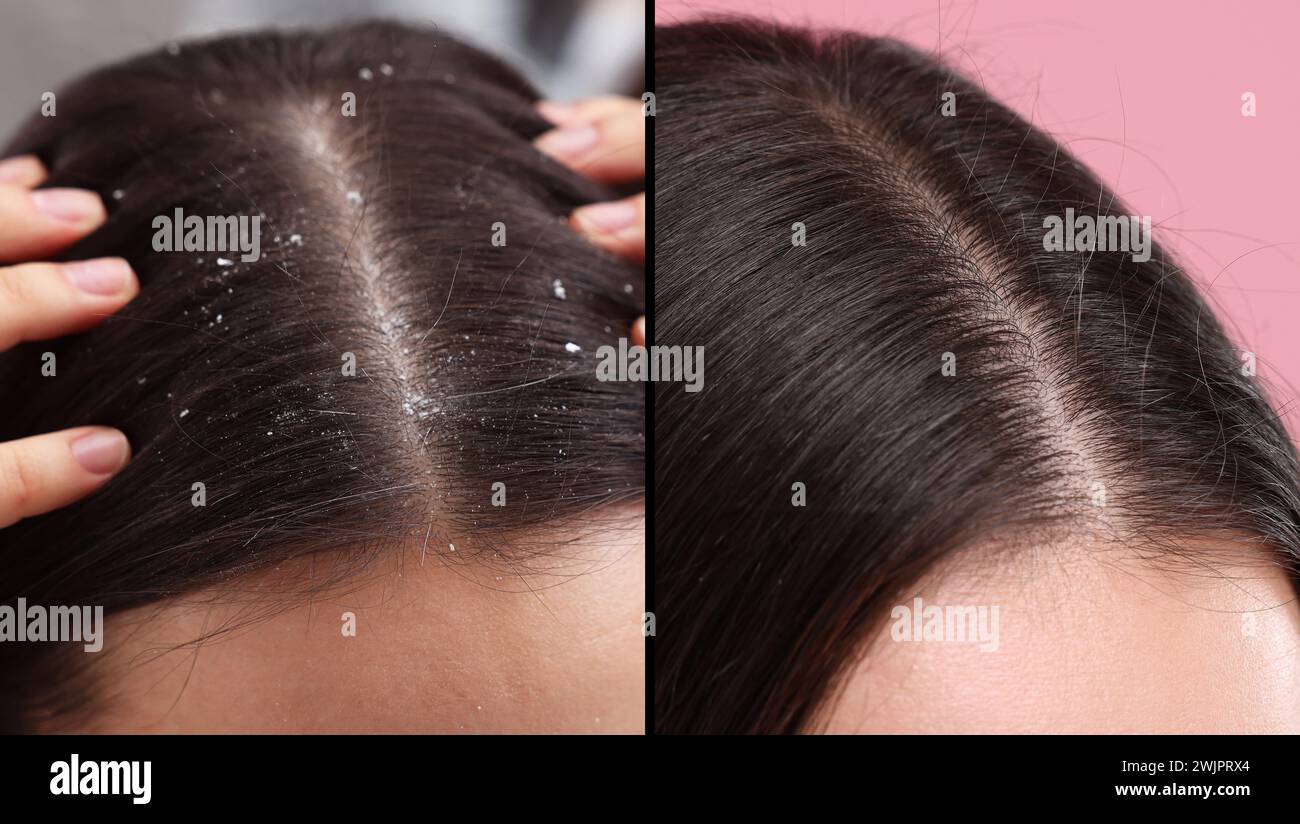 Woman Showing Hair Before And After Dandruff Treatment Collage Stock