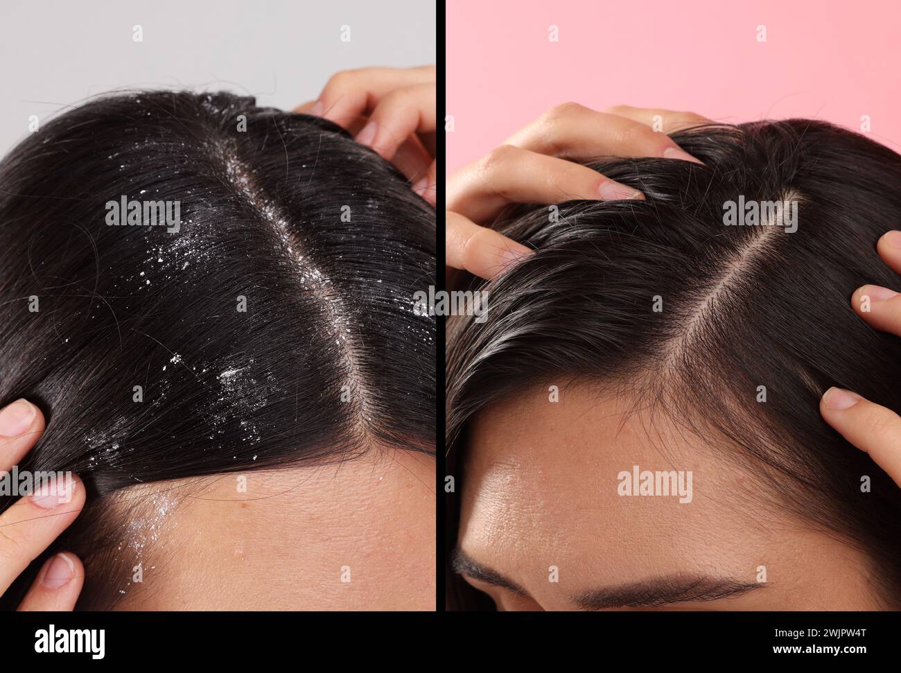 Woman showing hair before and after dandruff treatment on color ...