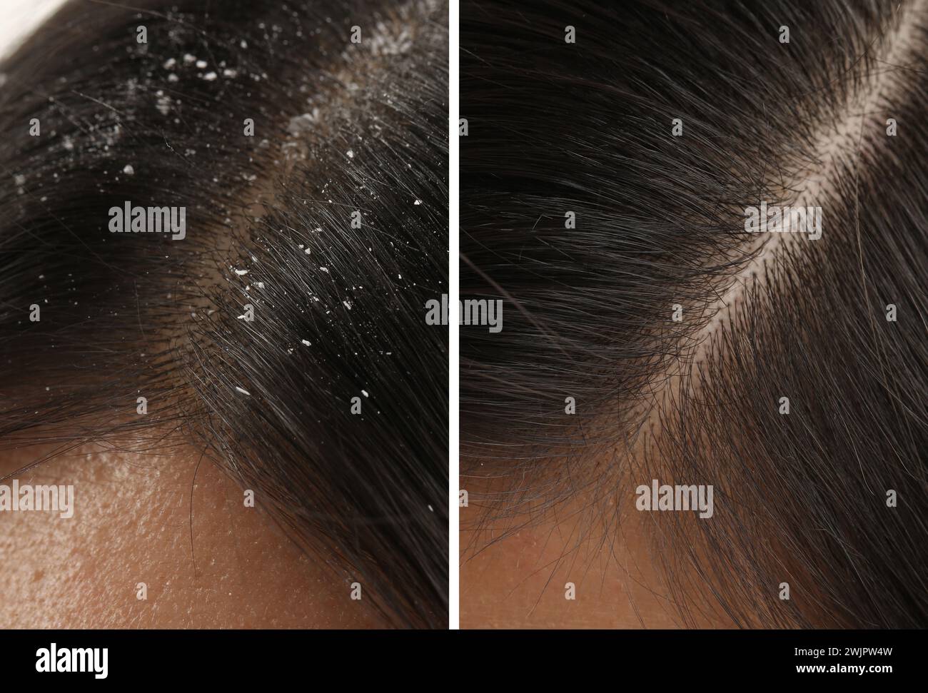 Woman showing hair before and after dandruff treatment, collage Stock Photo - Alamy