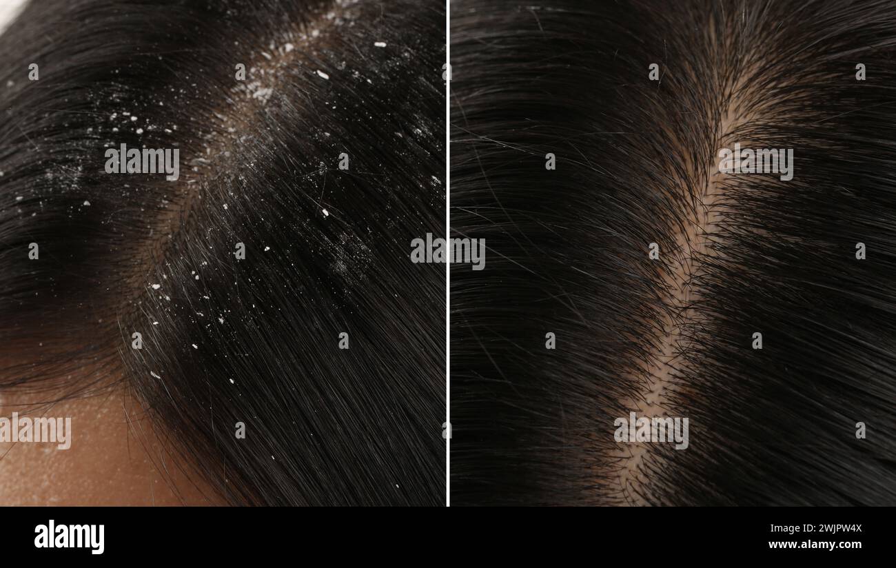 Woman Showing Hair Before And After Dandruff Treatment Collage Stock