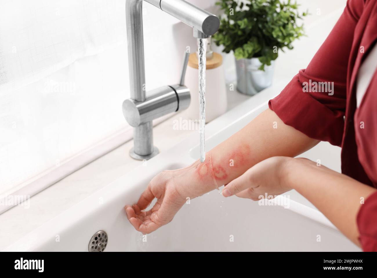 Woman putting hand with burns under cold running water indoors, closeup ...