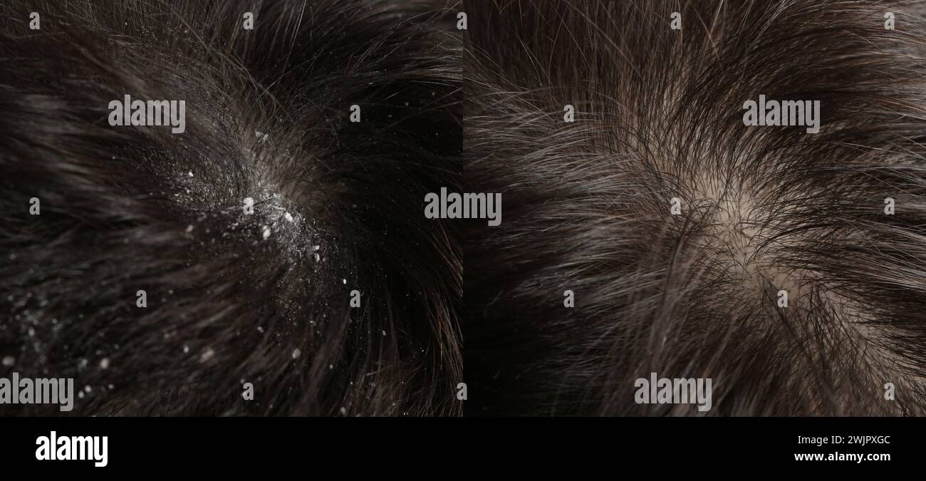 Man showing hair before and after dandruff treatment, collage Stock ...