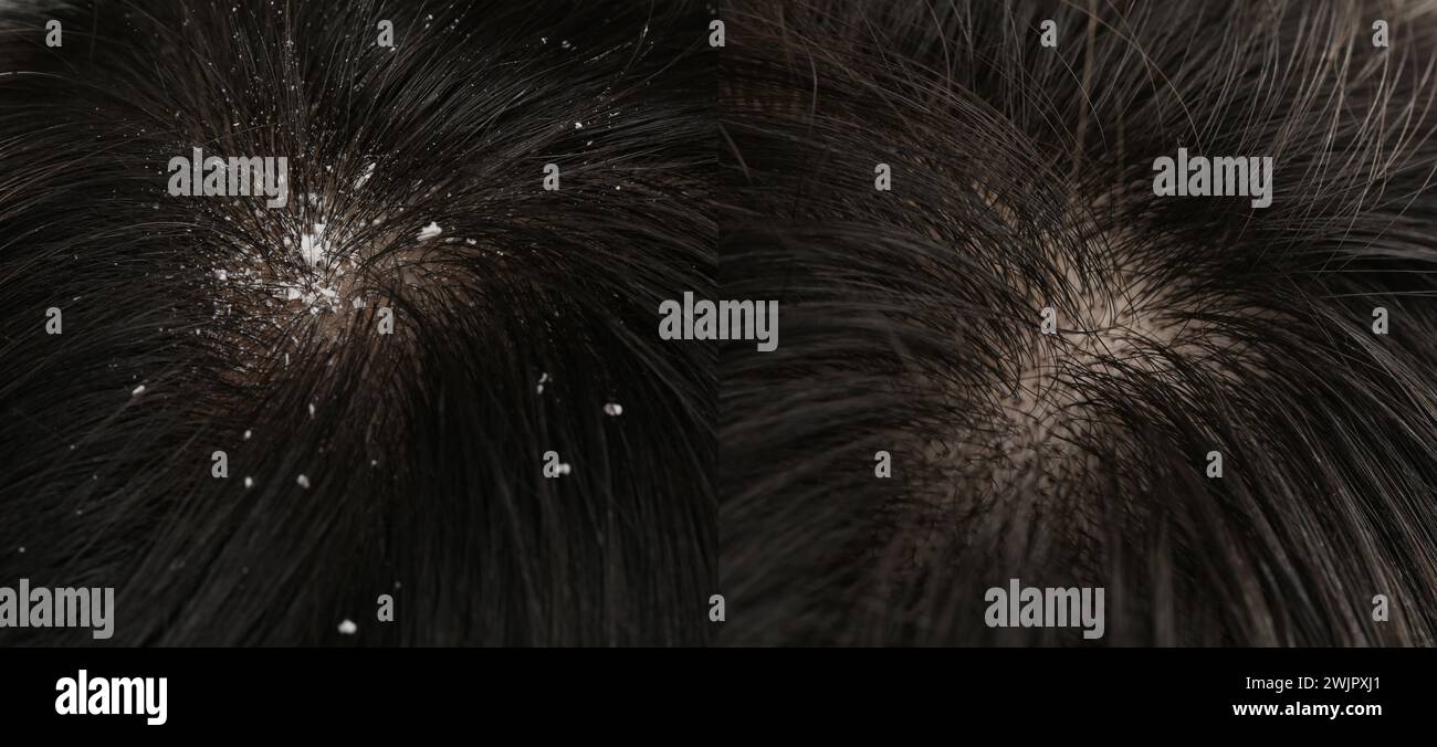 Woman showing hair before and after dandruff treatment, collage Stock ...