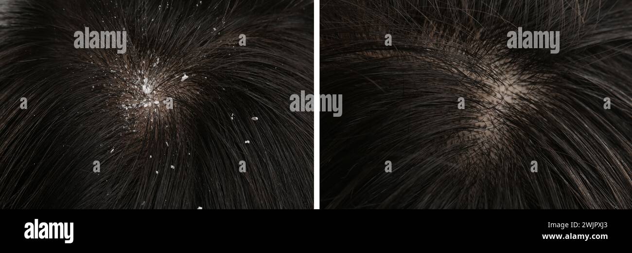 Woman Showing Hair Before And After Dandruff Treatment Collage Stock