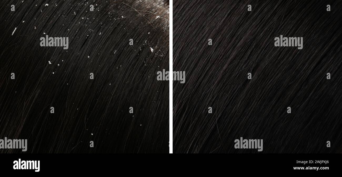 Woman showing hair before and after dandruff treatment, collage Stock ...