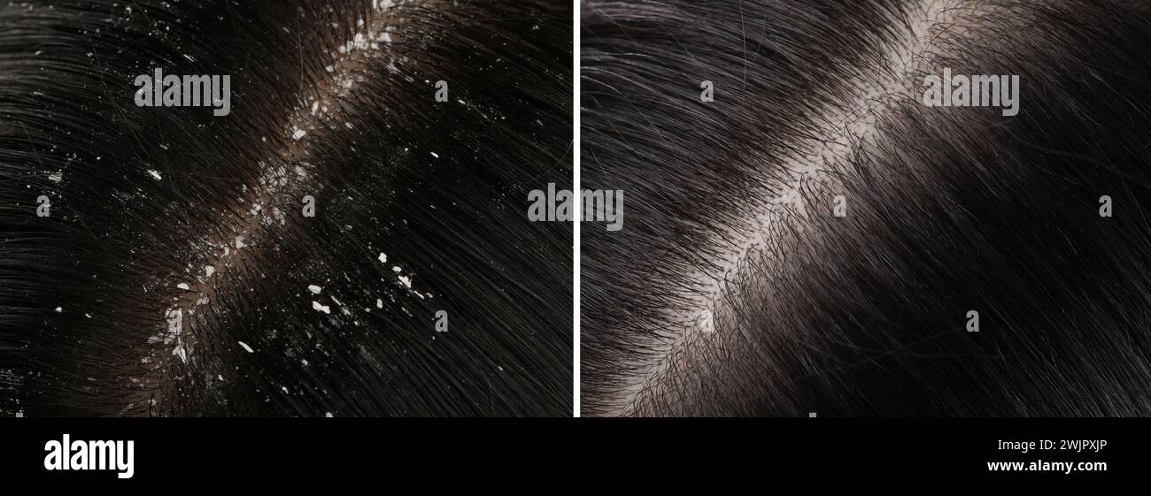 Woman Showing Hair Before And After Dandruff Treatment Collage Stock