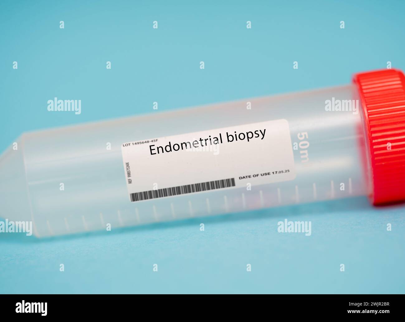 Endometrial biopsy. An endometrial biopsy is a procedure in which a ...
