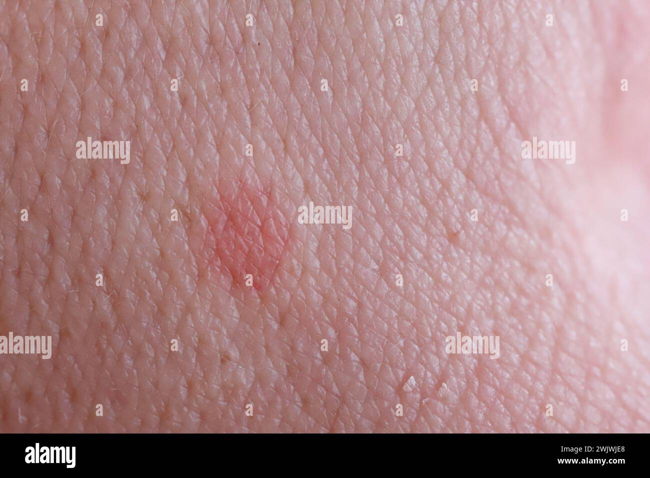 Reddened skin after being bitten by a drinking flea that feeds on human ...