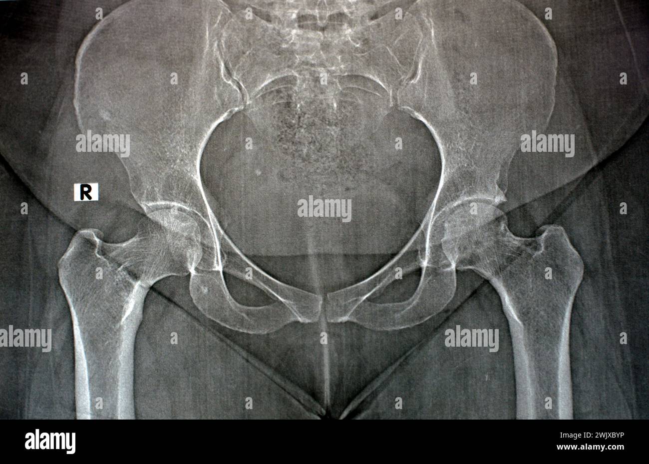 What Is Bilateral Femoral Head Avascular Necrosis at Gabriel Burnell blog