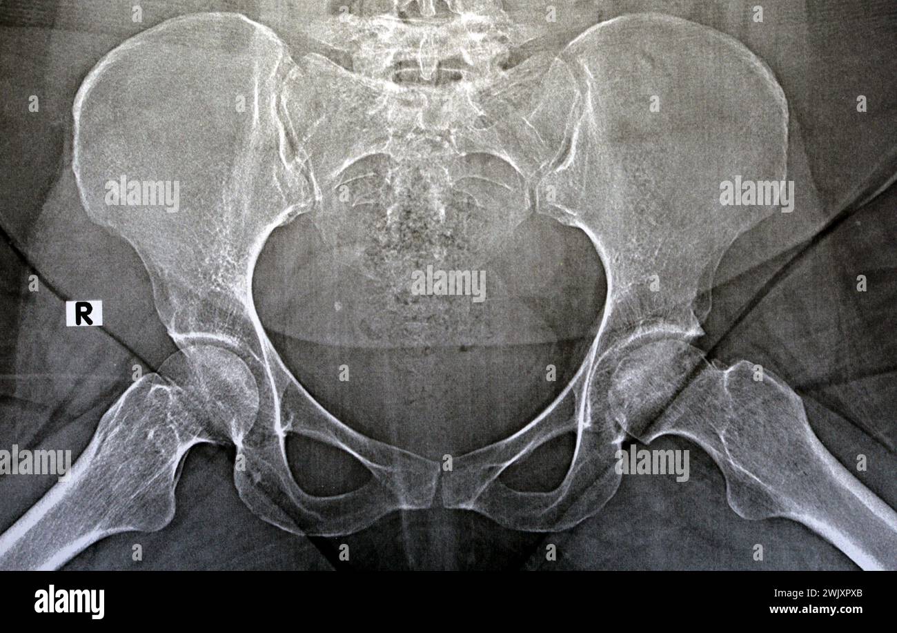 Necrosis hi-res stock photography and images - Alamy