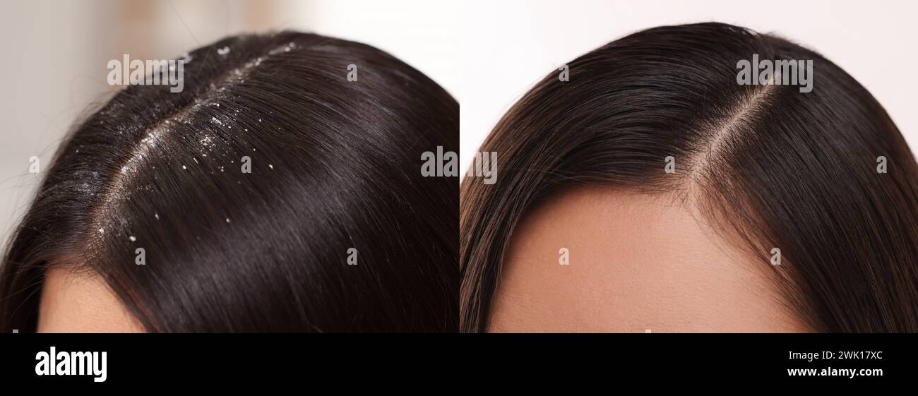 Woman showing hair before and after dandruff treatment, collage Stock ...