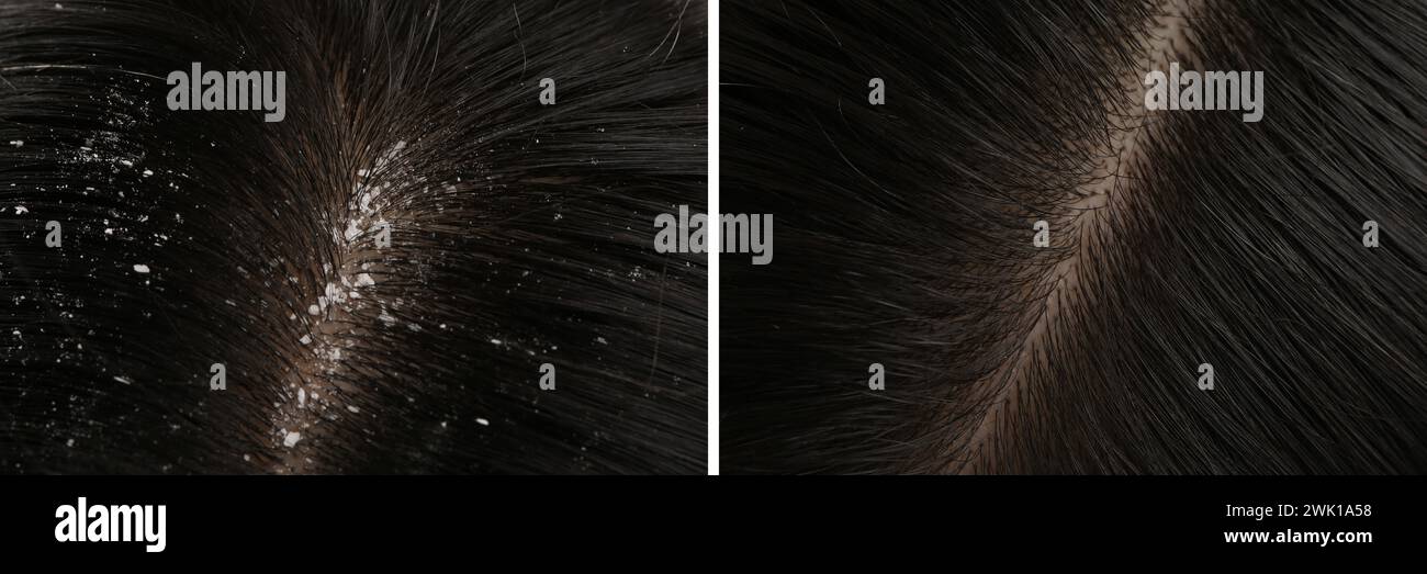 Woman showing hair before and after dandruff treatment, collage Stock ...