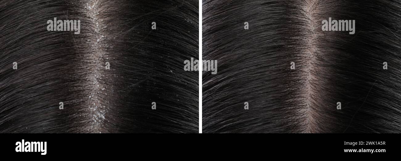 Woman showing hair before and after dandruff treatment, collage Stock ...
