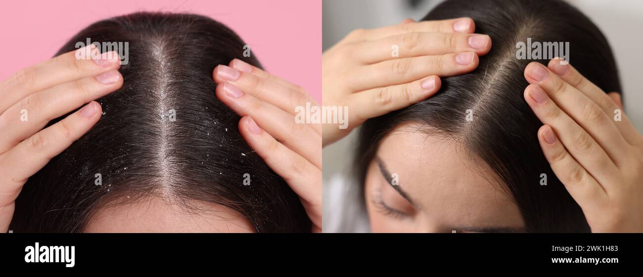 Woman showing hair before and after dandruff treatment on color ...