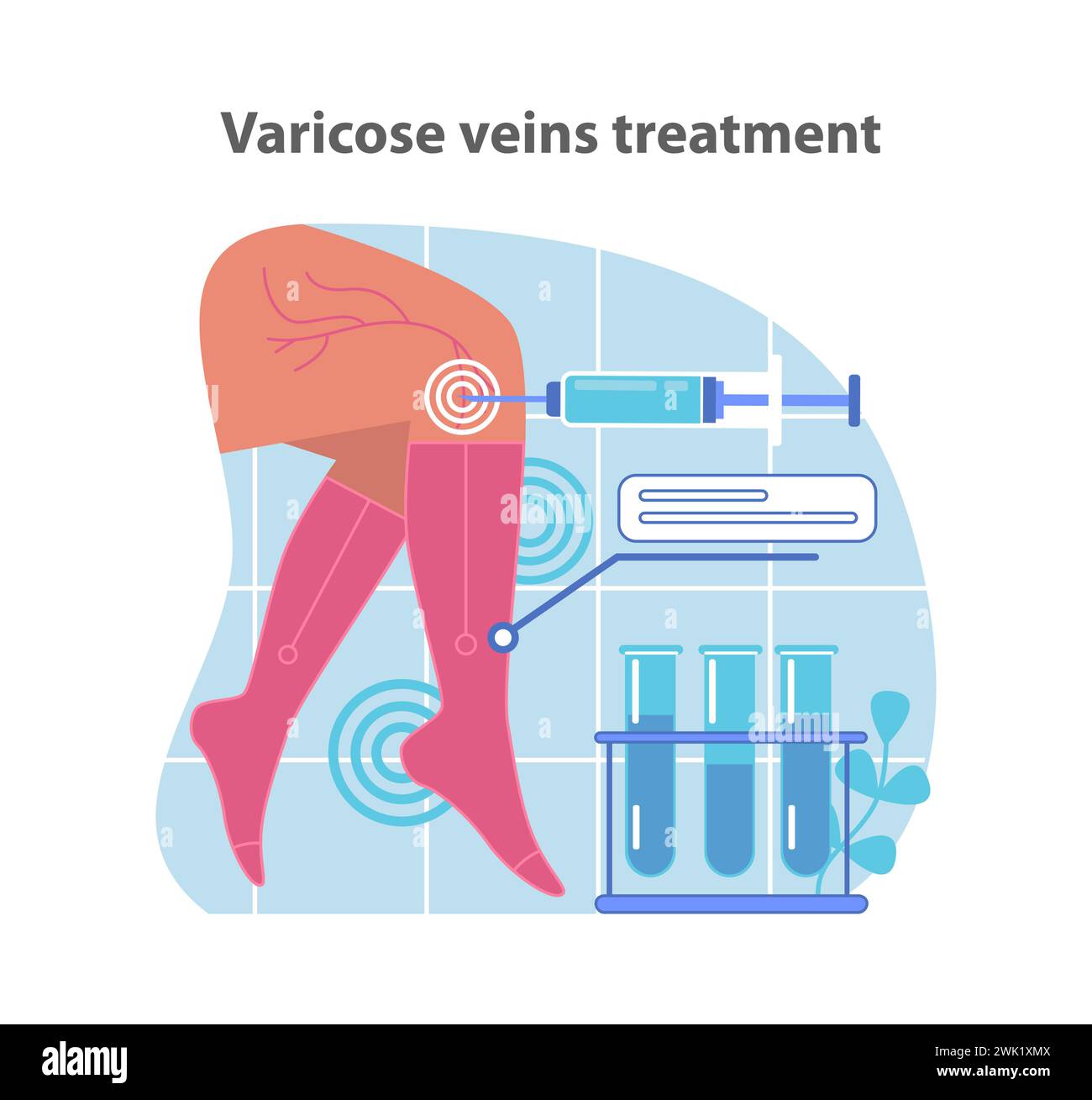 Specialized varicose veins treatment. A medical illustration depicting ...