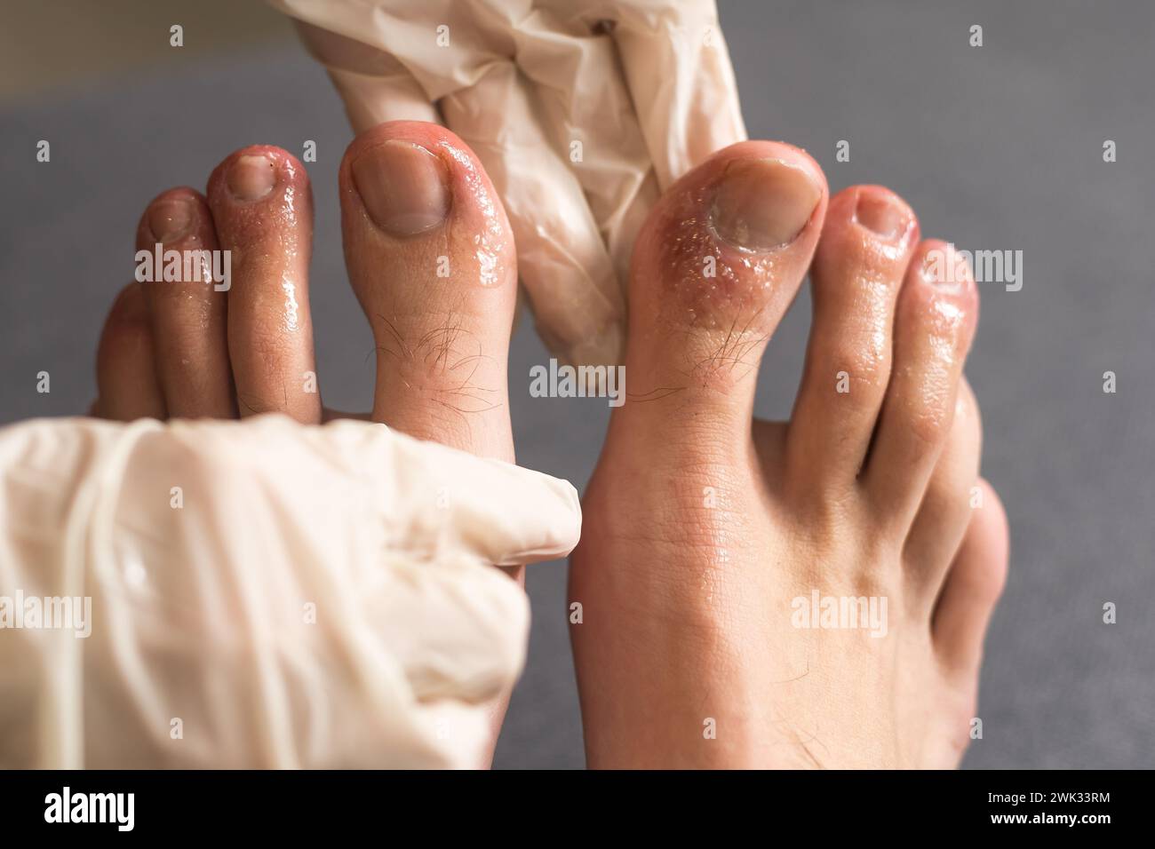 Spider bite and adult hi-res stock photography and images - Alamy