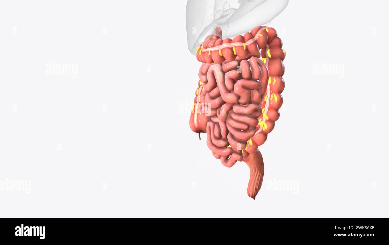Peritoneal inflammation hi-res stock photography and images - Alamy