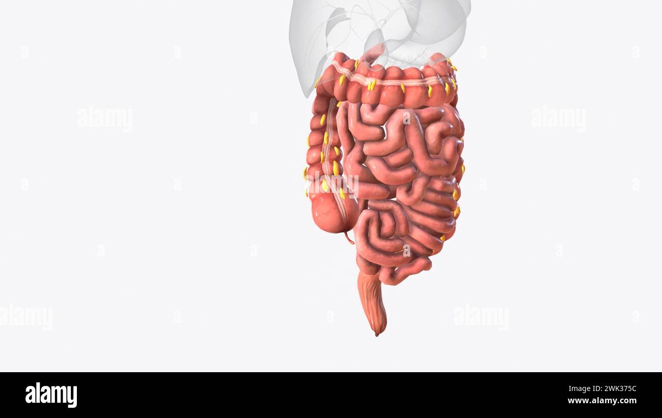 Peritoneal inflammation hi-res stock photography and images - Alamy