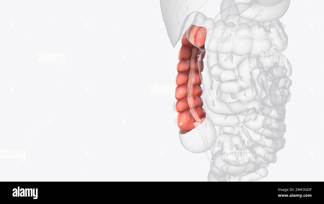 The ascending colon (or right colon) is the beginning part of the colon ...