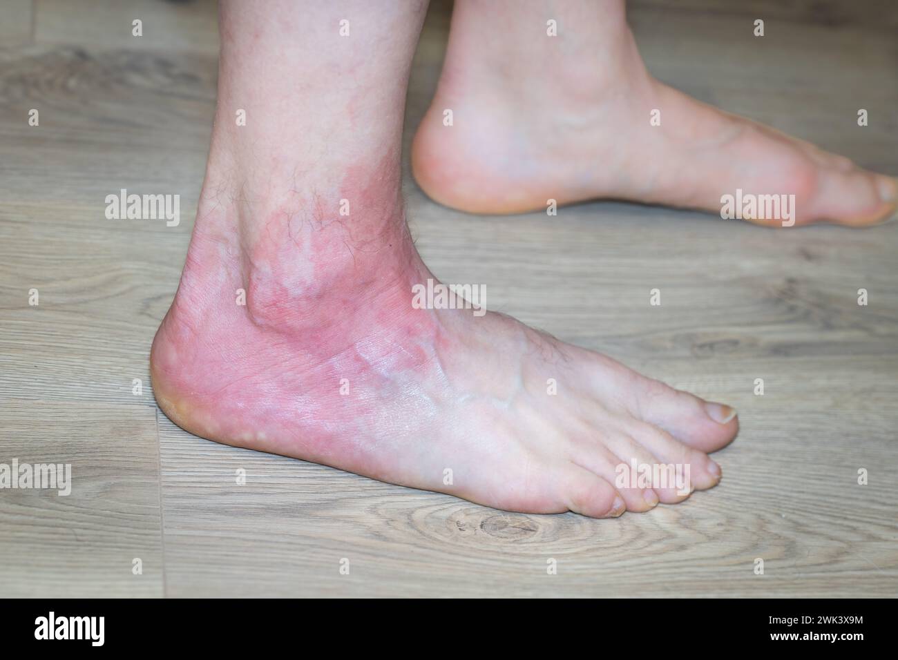 acute allergy, swollen and red foot, allergic reaction, itchy skin ...