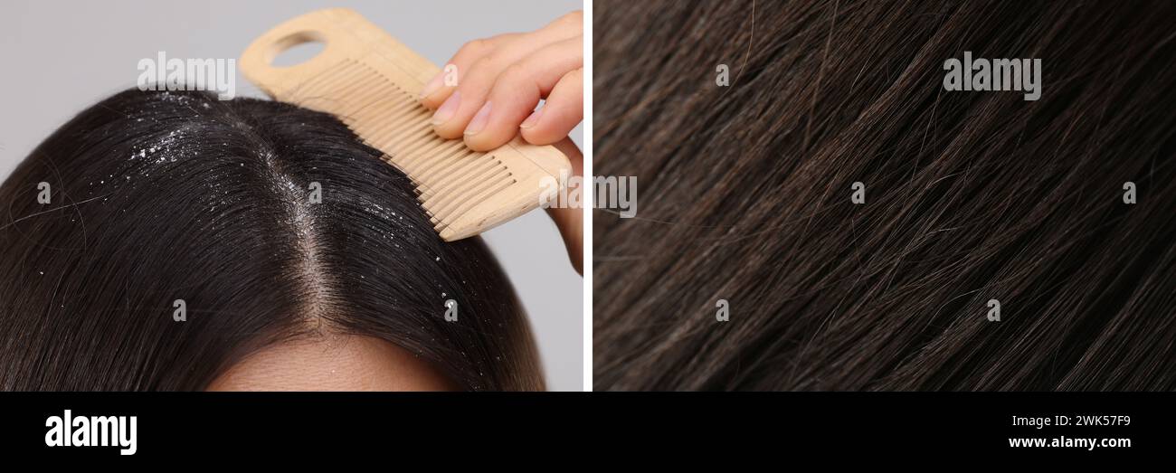Woman Showing Hair Before And After Dandruff Treatment Collage Stock