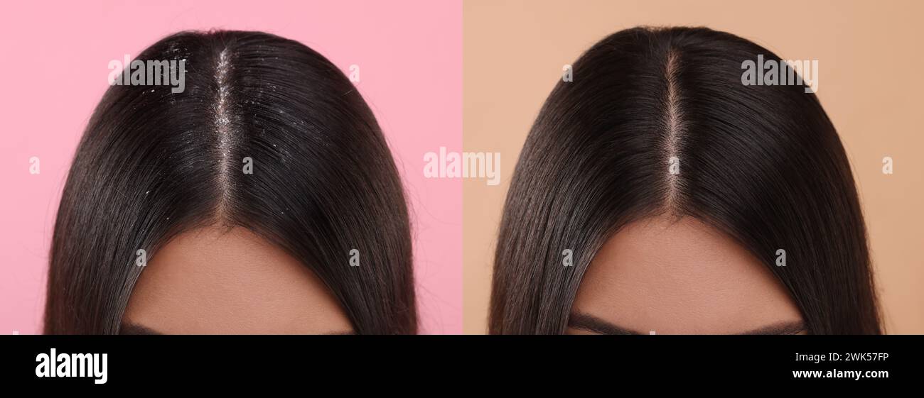 Woman Showing Hair Before And After Dandruff Treatment On Color