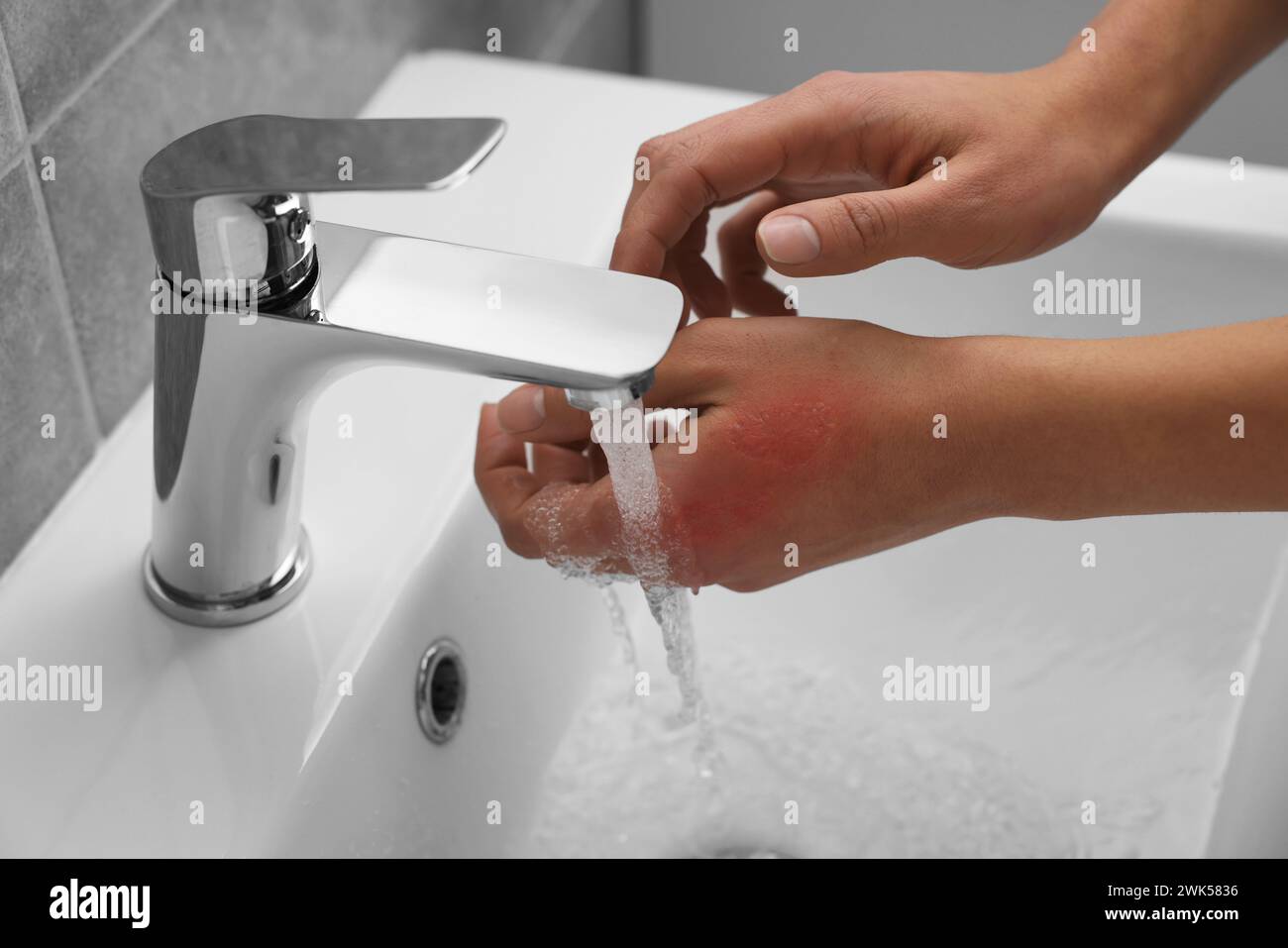 Burned hand hot water hi-res stock photography and images - Alamy
