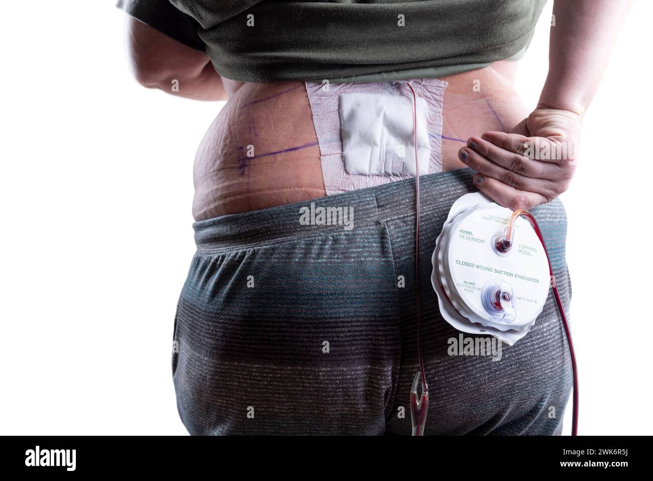 Back view of a person with a large spine bandage and drain tubing ...