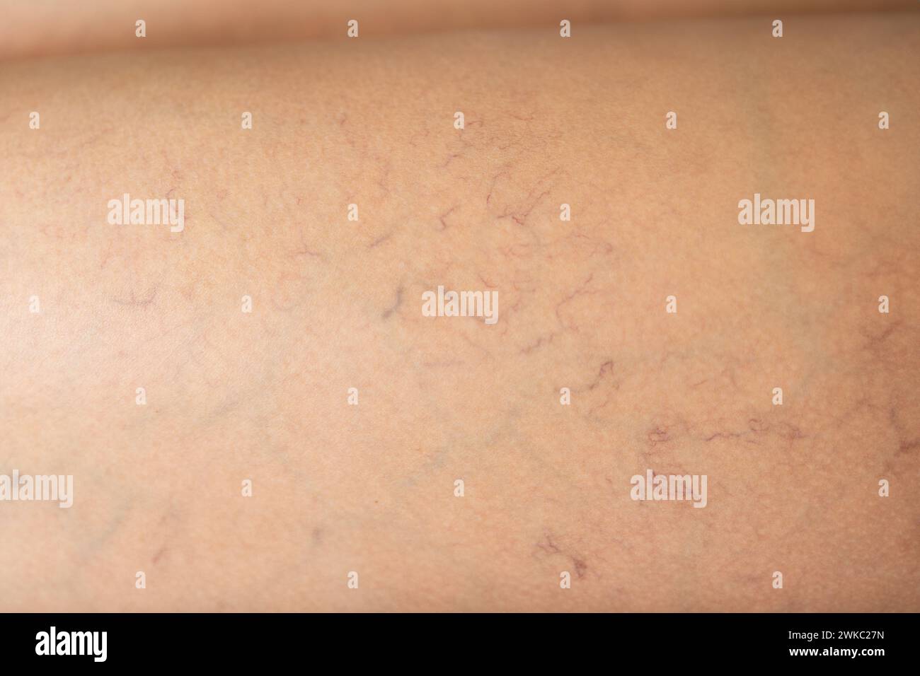 Varicose veins of small vessels on the skin of a woman's thigh Stock ...