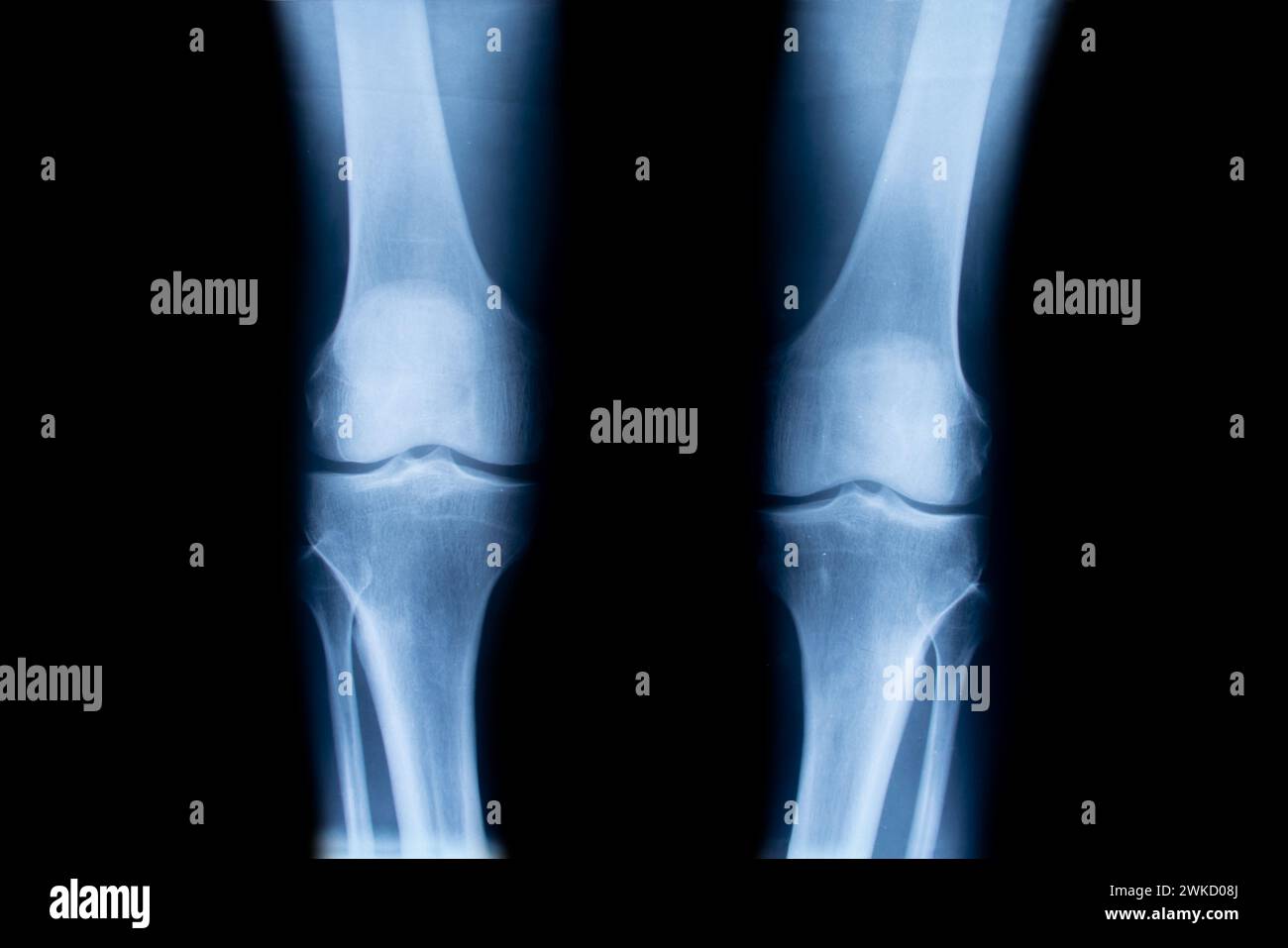 X-ray of human knees, closeup Stock Photo - Alamy