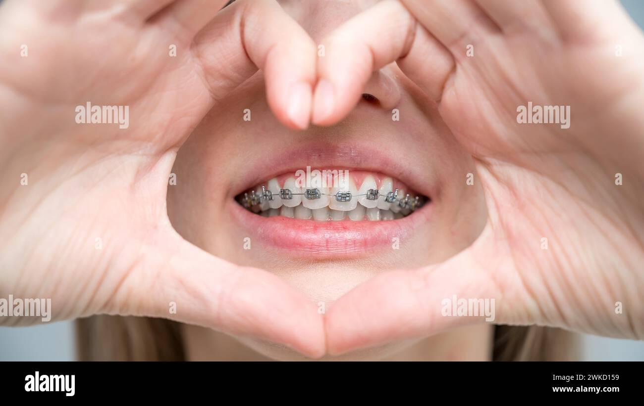 Caucasian woman in braces holding fingers in the shape of a heart Stock ...