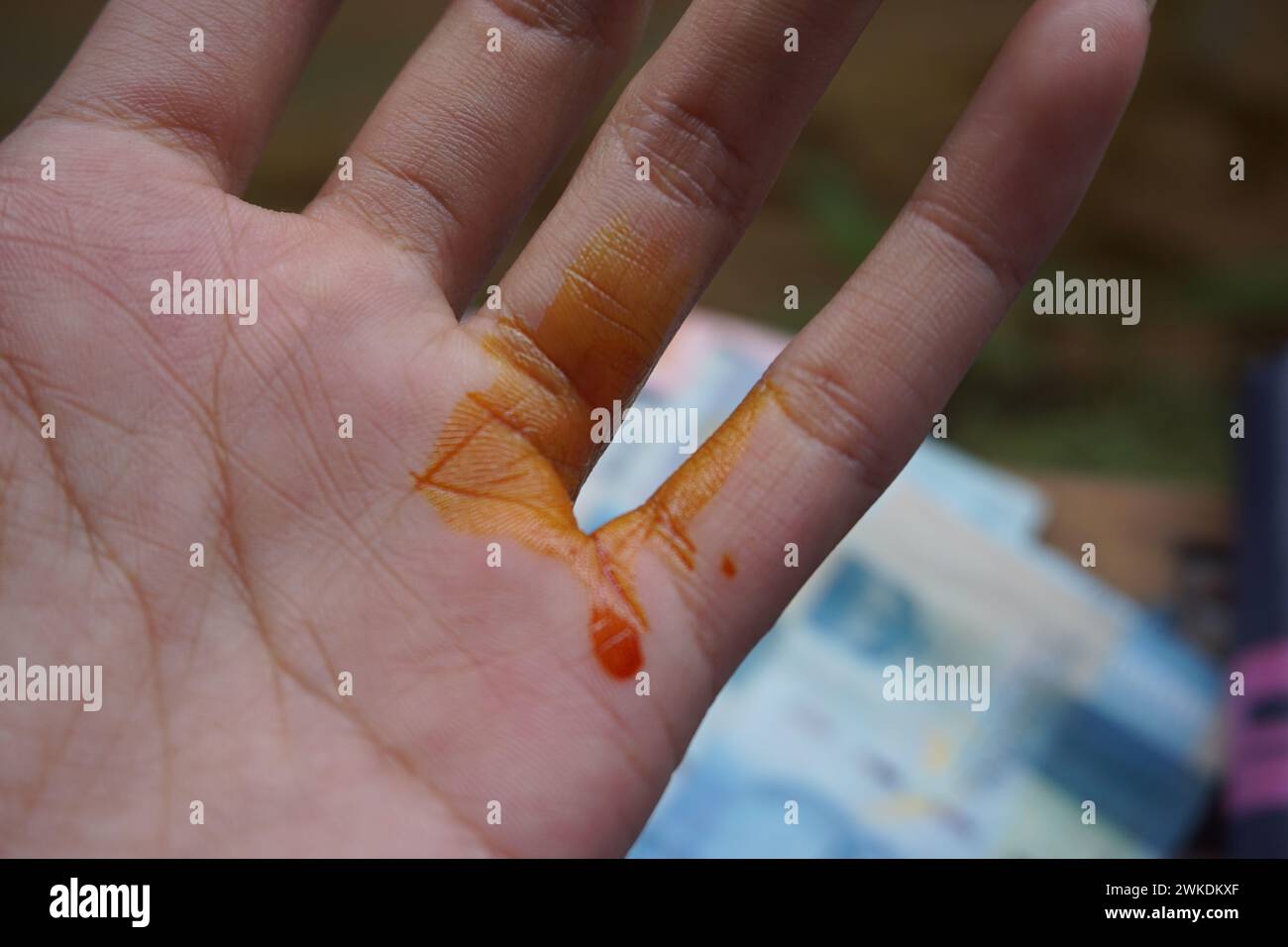 Stock photo of sores forming scabs on hands and arms. Injury occurred ...