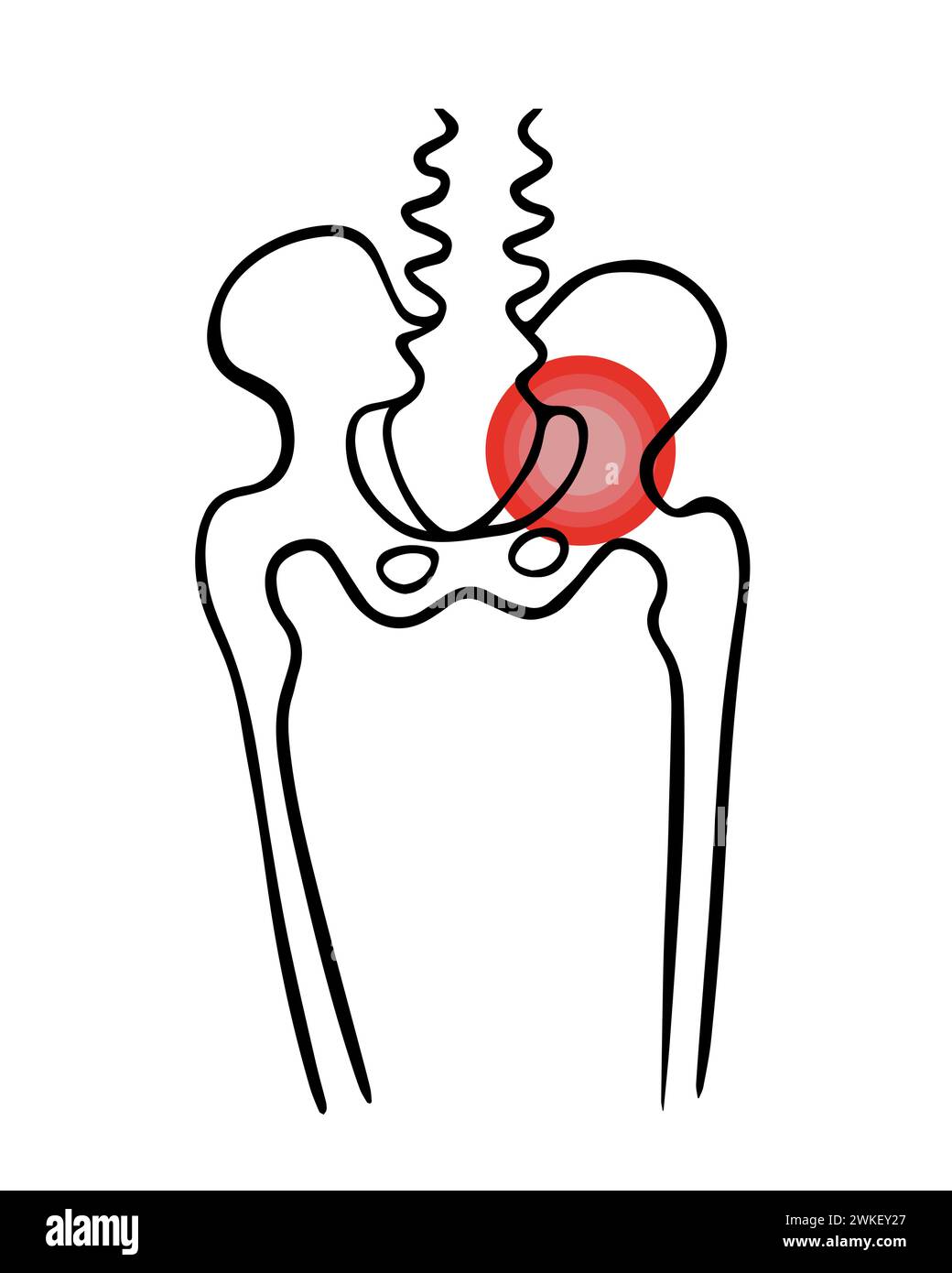 Vector isolated illustration of pelvic bone injury. Pelvic fracture ...