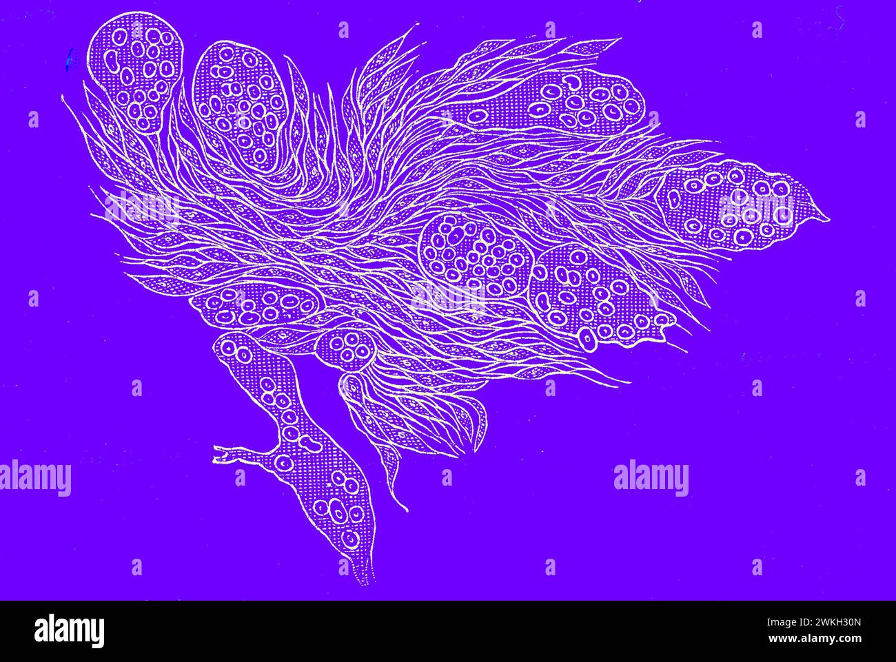 Spindle cell sarcoma, 19th century illustration Stock Photo - Alamy