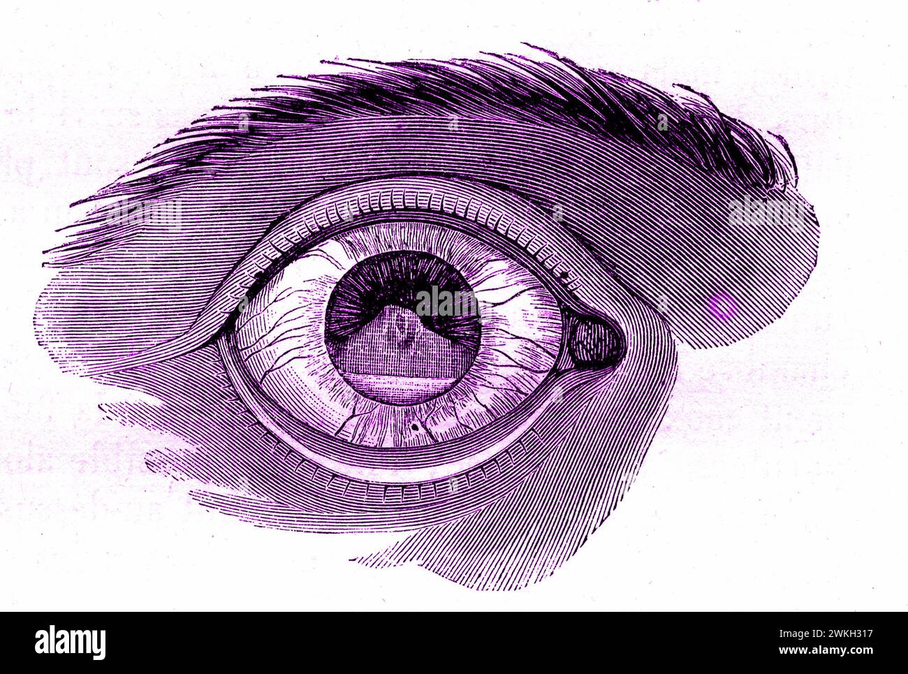 Corneal abscess and hypopyon, 19th century illustration Stock Photo - Alamy
