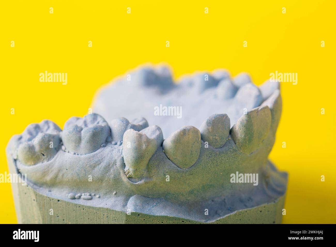 Blue plaster model of an impression of a patient's jaw at an ...