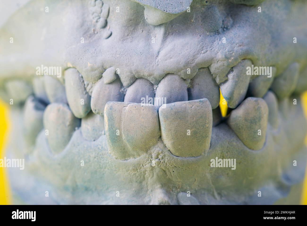 Blue plaster impression of the dental jaw of a patient with crooked ...