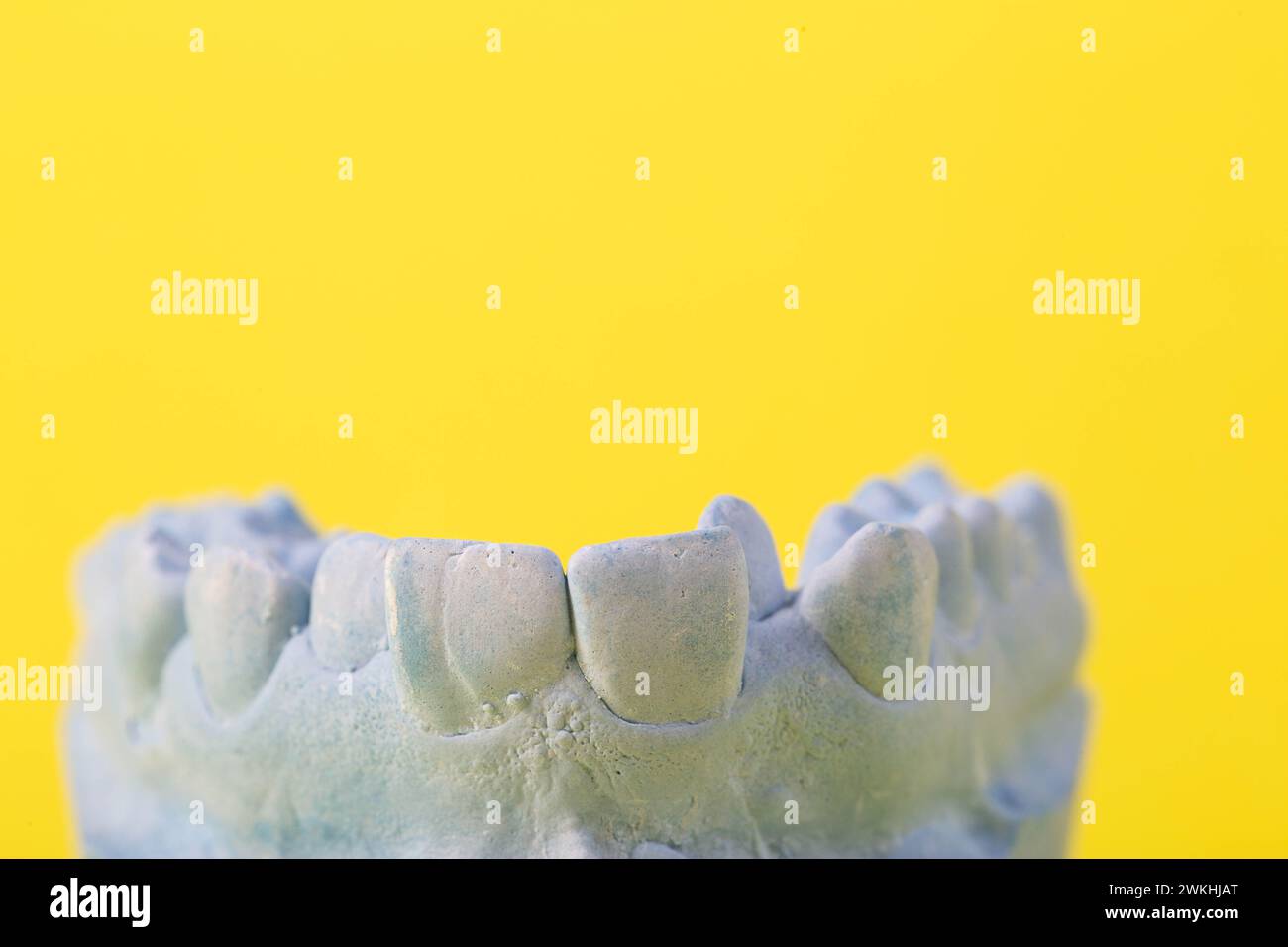 Blue plaster model of an impression of a patient's jaw at an ...