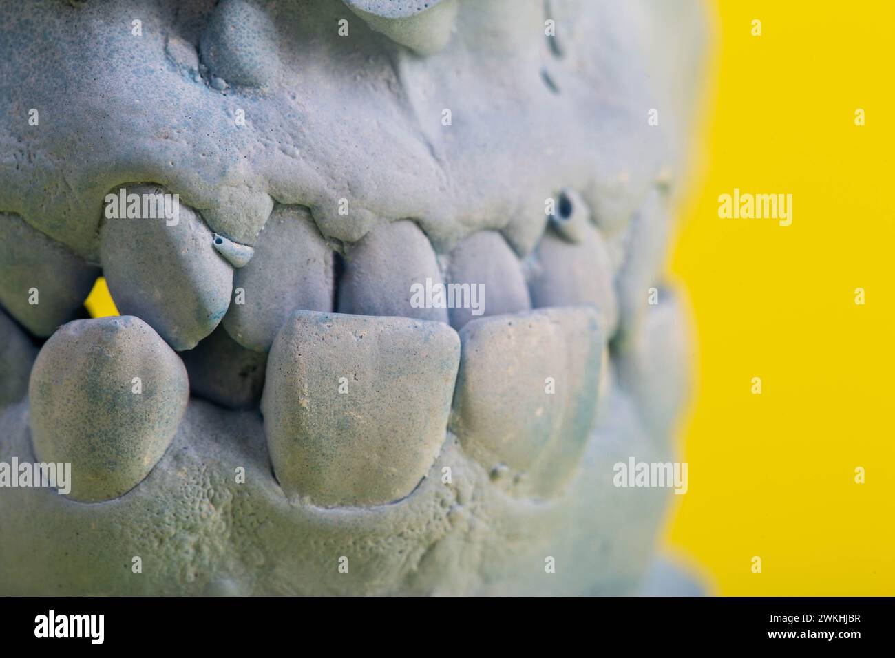 Blue plaster impression of the dental jaw of a patient with crooked ...